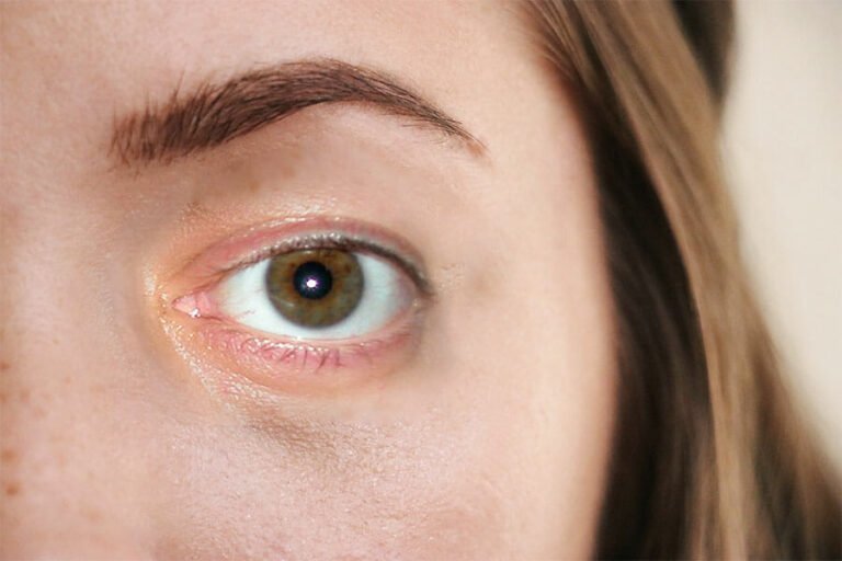 What Are Protruding Eyes - Here We Have Your Answers